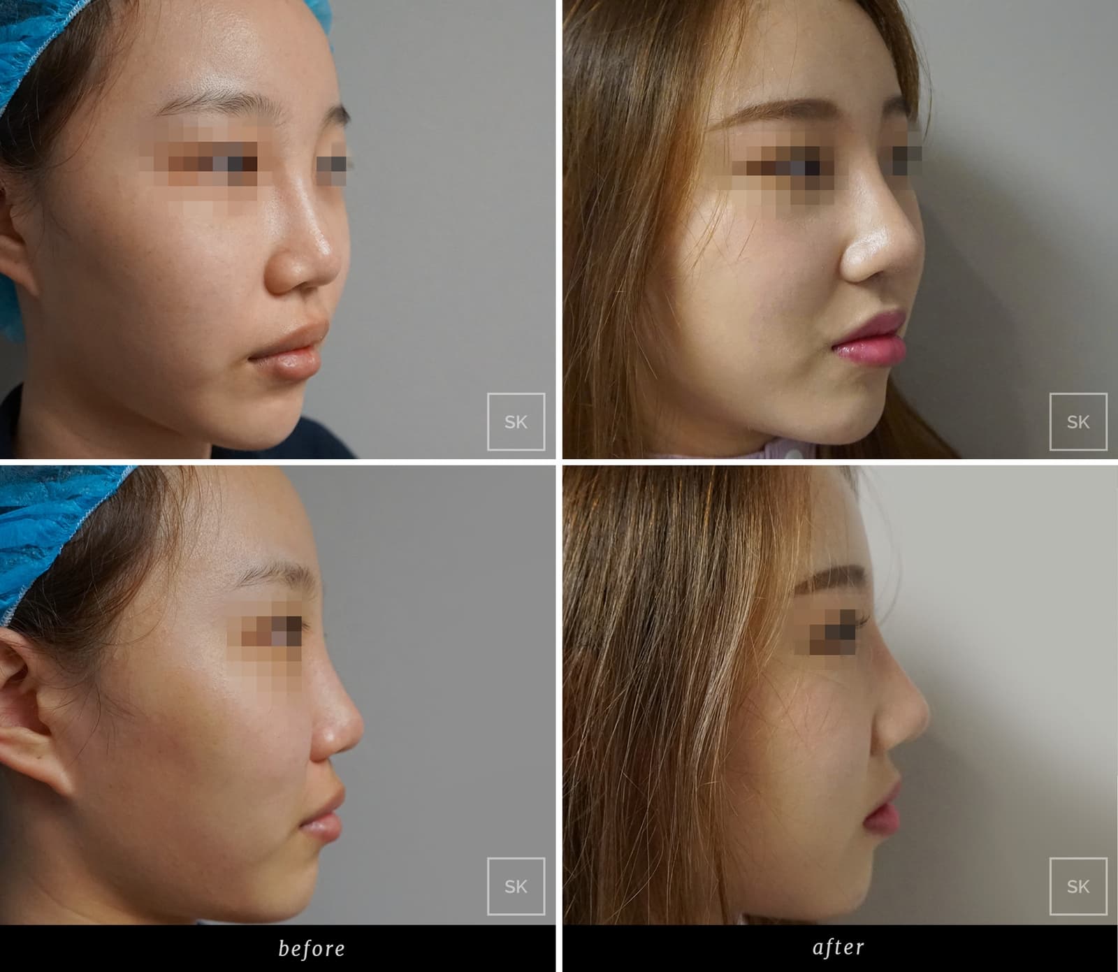 Before and After Nose Surgery Photos - SK Plastic Surgery