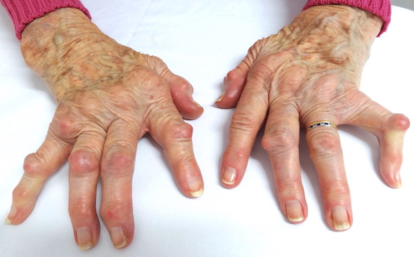 Ganglion cyst of the wrist