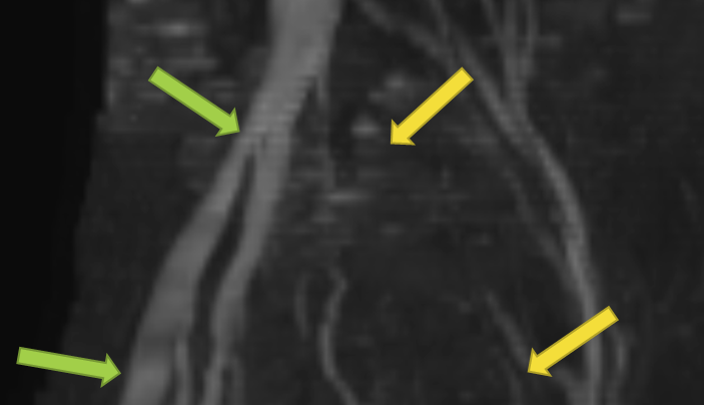 Venous claudication post iliofemoral DVT | Michael Cumming, MD, MBA