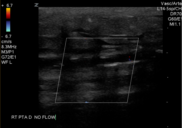 Cholesterol embolization after lower extremity revascularization ...
