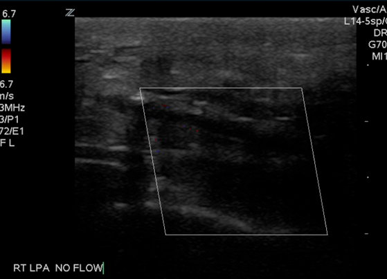 Cholesterol embolization after lower extremity revascularization ...