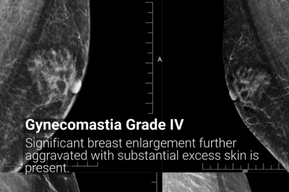 Gynecomastia 101 | Amaris B. Clinic by Dr Ivan Puah