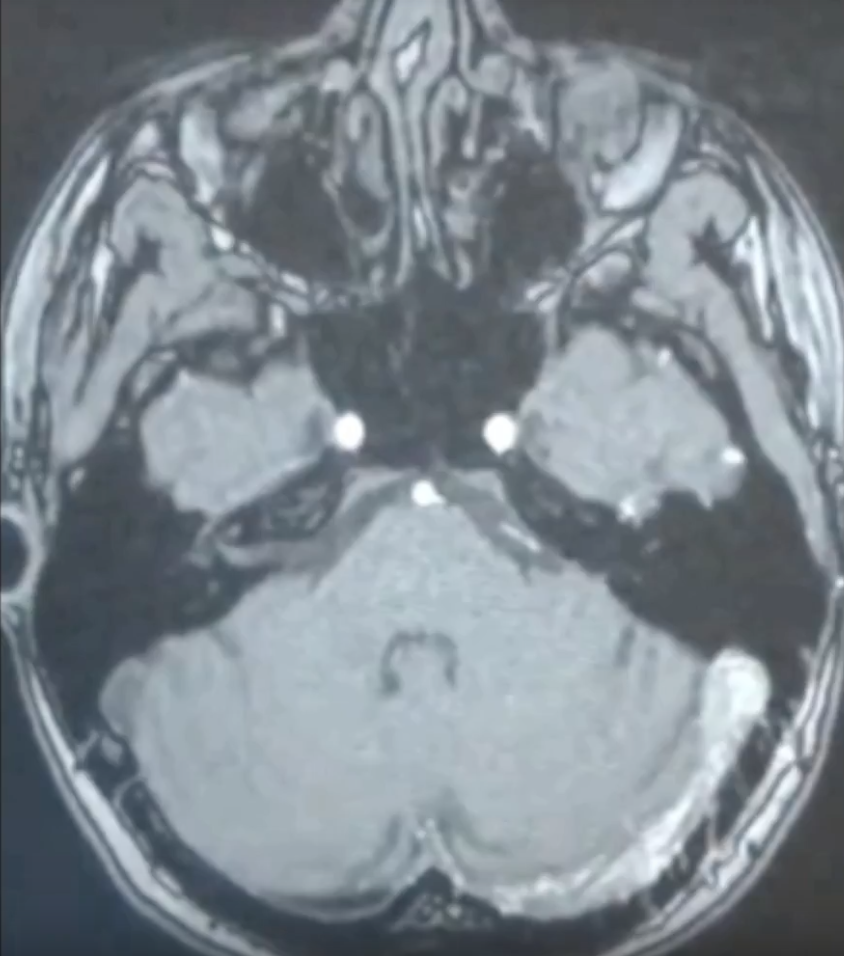 Hérnia de Uncus | SIR - Serviços e Residência Médica em Radiologia