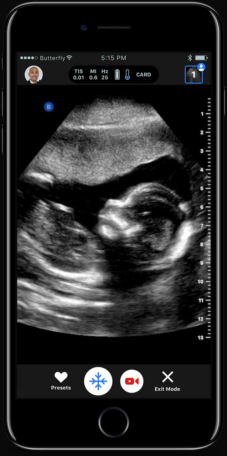 Meet Butterfly iQ - Whole body imaging, under $2k