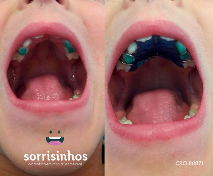 Pistas Diretas de Planas