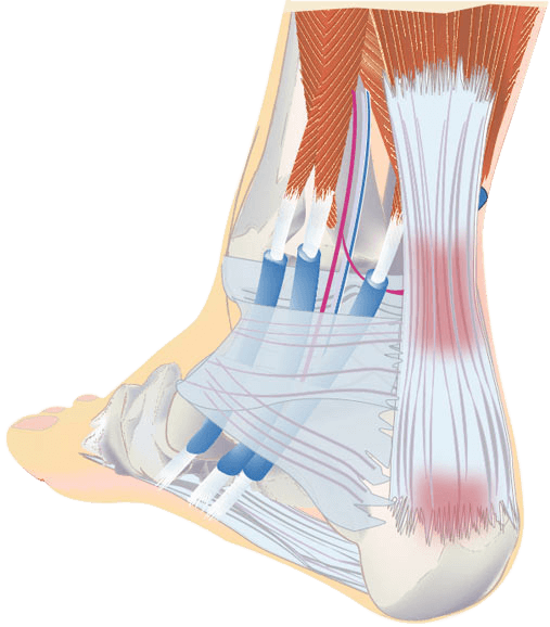 Types of Heel Pain | Heal My Heel