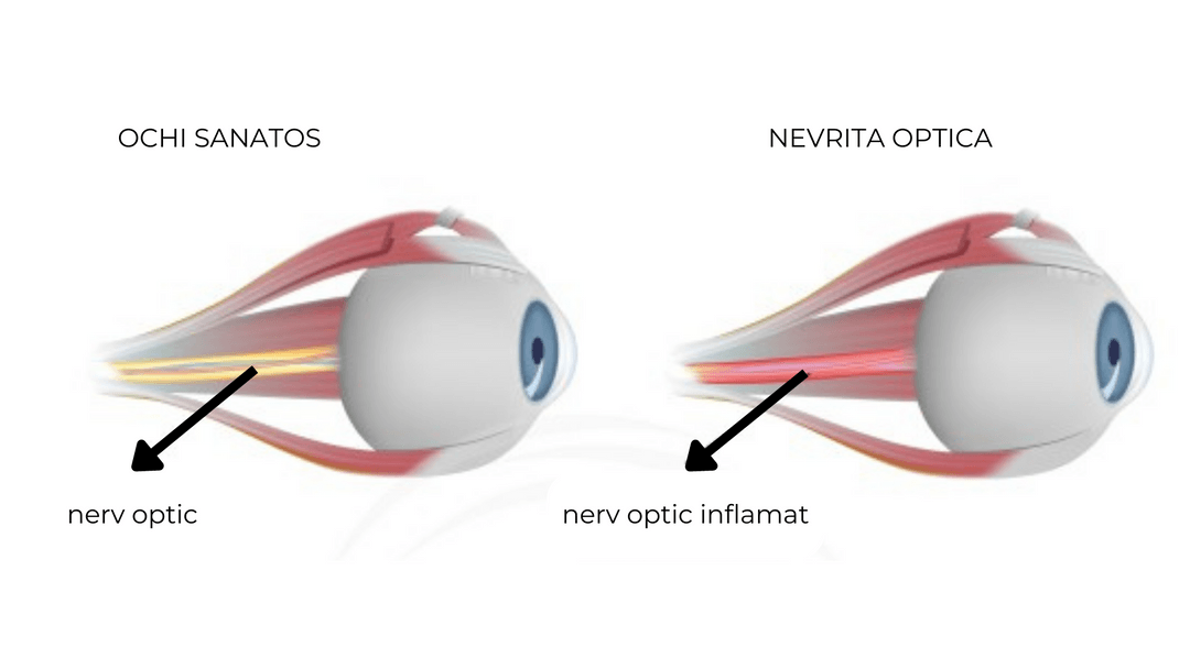 Ce este nevrita optica