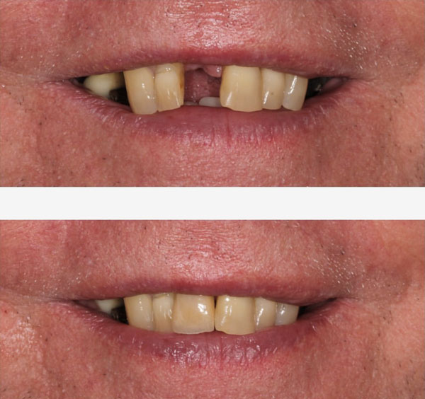 Replace Missing Teeth Birmingham