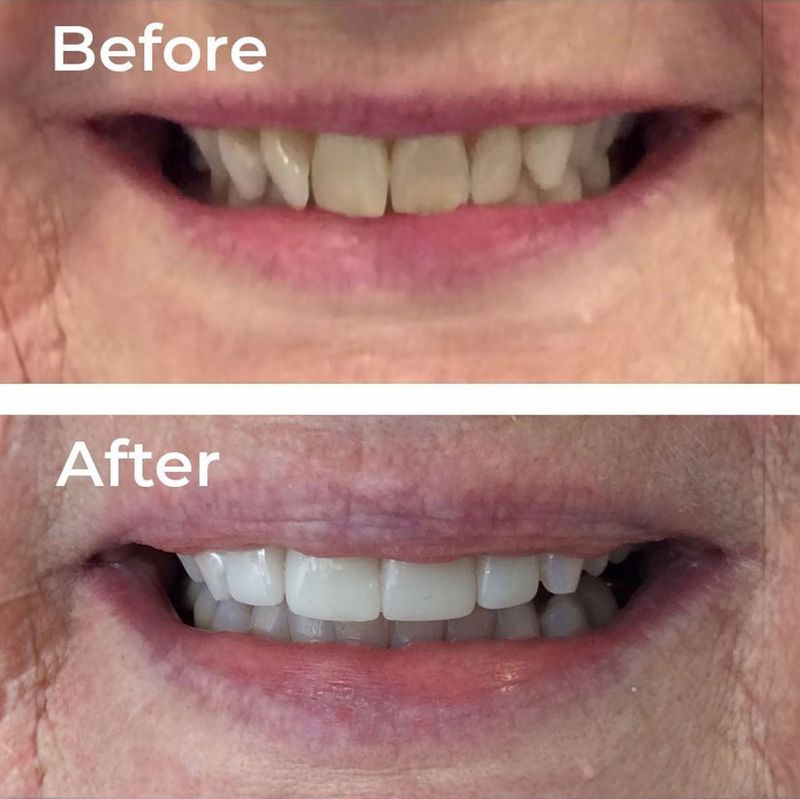Dental Veneers Birmingham - Porcelain Veneers