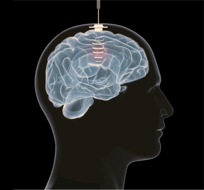 Carthera publie les résultats essai clinique utilisant l'implant ...