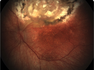 Icon Retinal Imaging System