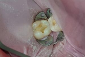 Safe Amalgam Fillings Removal - Indianapolis Dentistry | Indianapolis ...