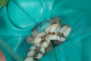 Safe Amalgam Fillings Removal - Indianapolis Dentistry | Indianapolis ...