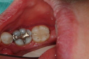 Safe Amalgam Fillings Removal - Indianapolis Dentistry | Indianapolis ...