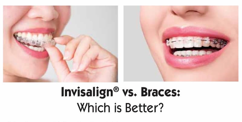 Invisalign vs. Braces – Which is Better for You?