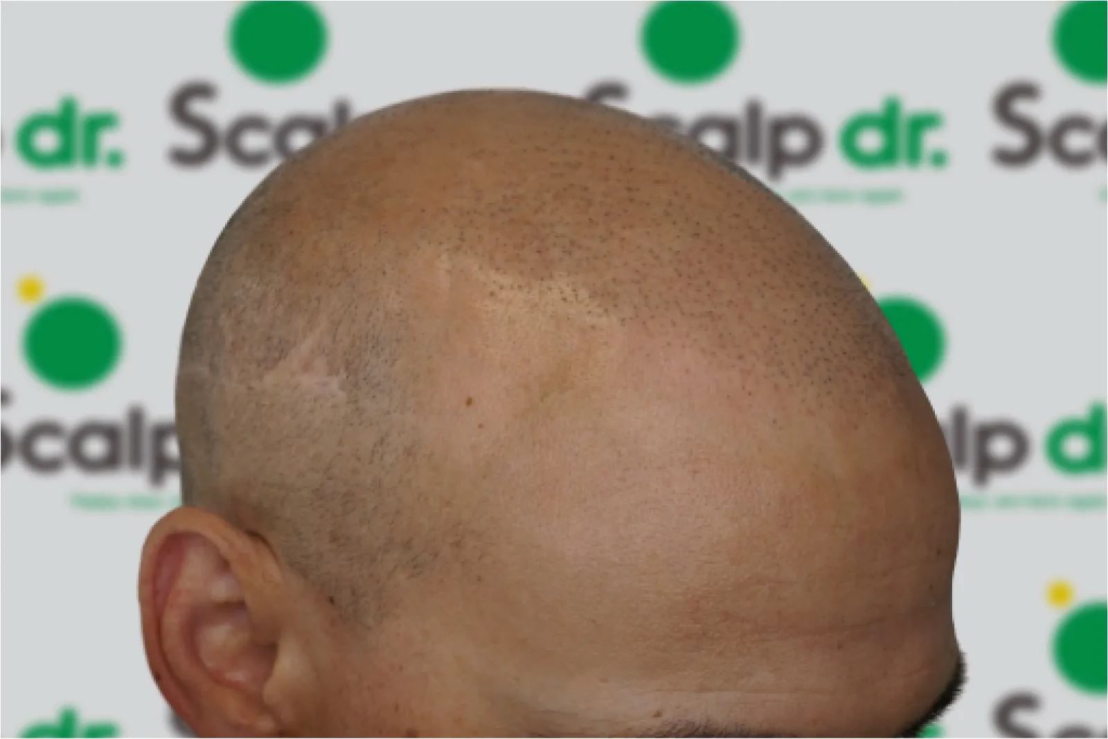 Scar Camouflage | SMP Image Gallery | Scalp Dr.
