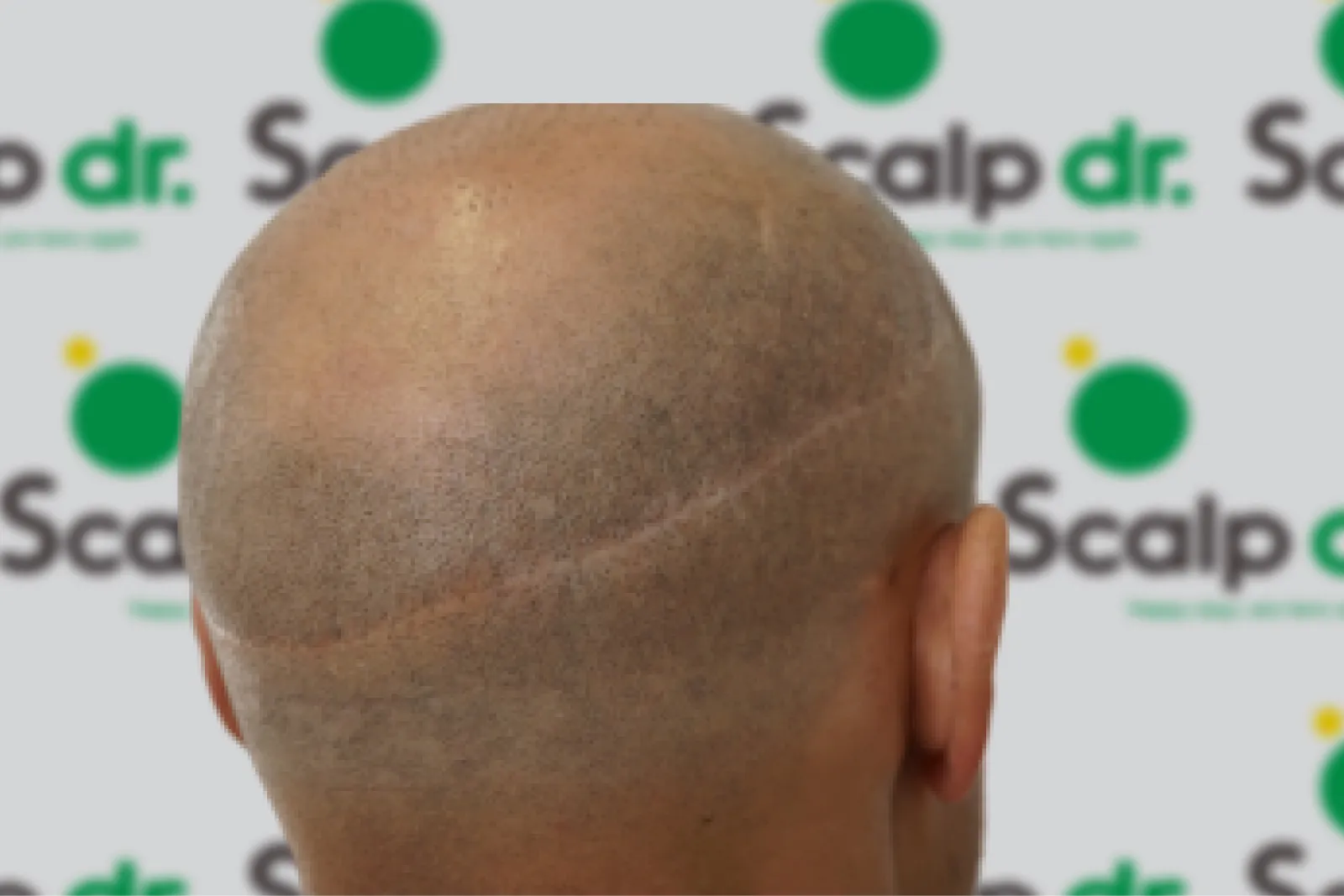 Scar Camouflage | SMP Image Gallery | Scalp Dr.