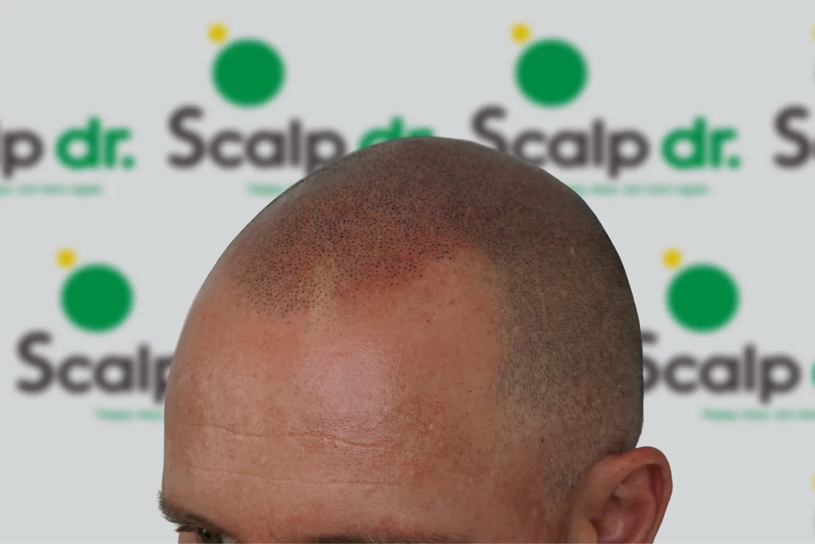 SMP for Men | SMP Image Gallery | Scalp Dr.