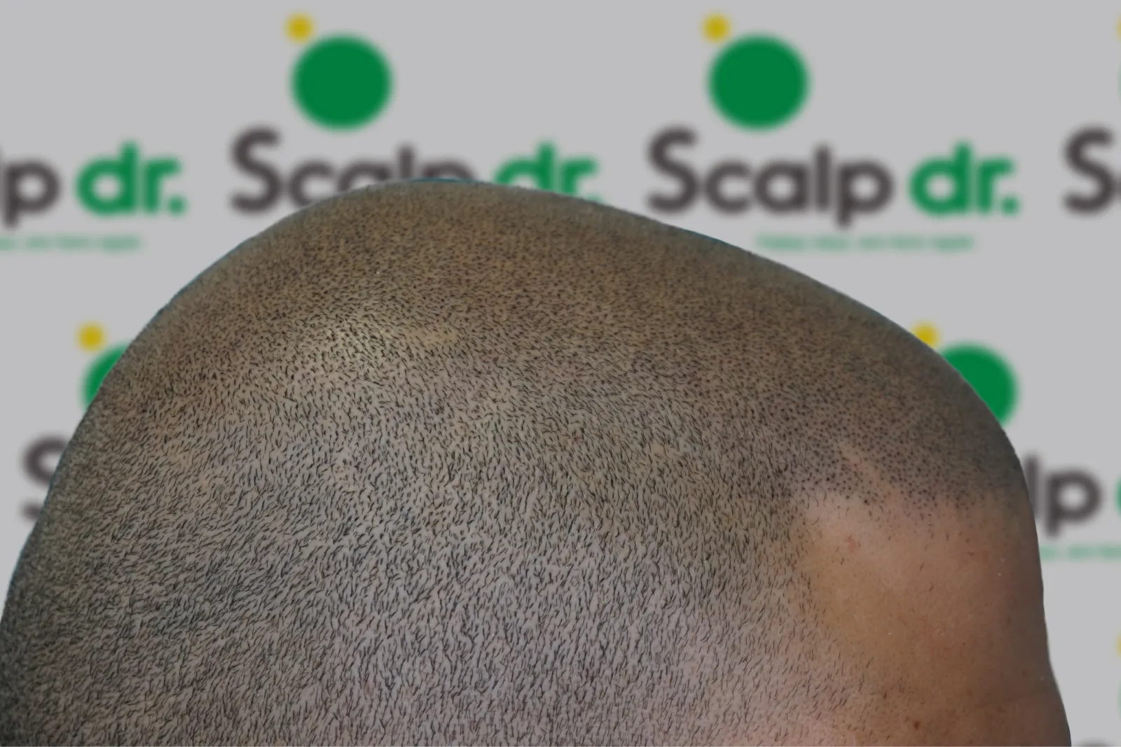 SMP for Men | SMP Image Gallery | Scalp Dr.