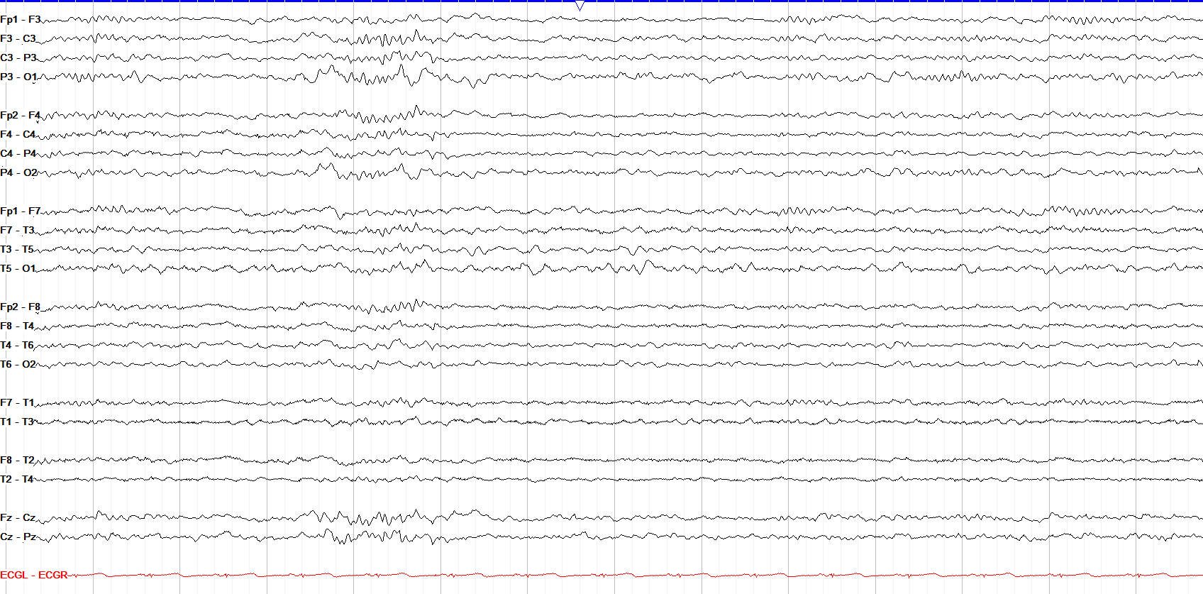 The Normal Asleep EEG