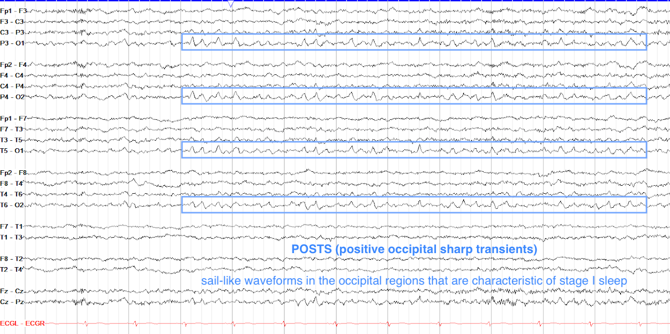 The Normal Asleep EEG