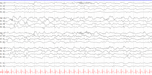 Epileptiform Activity on EEG
