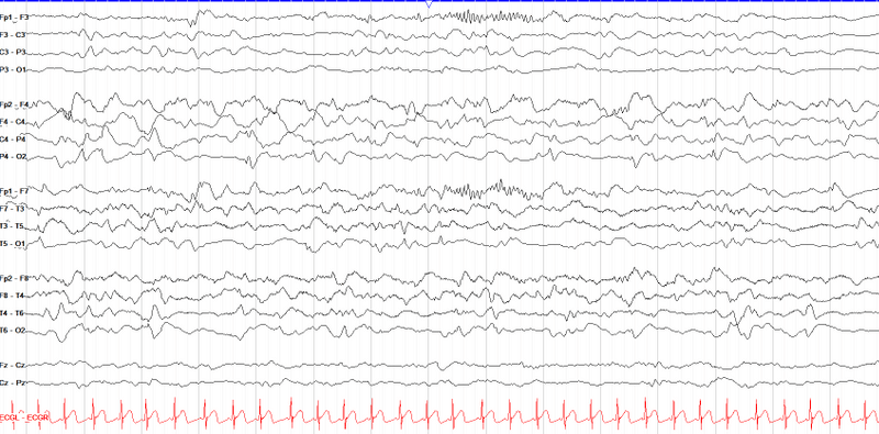 Epileptiform Activity on EEG