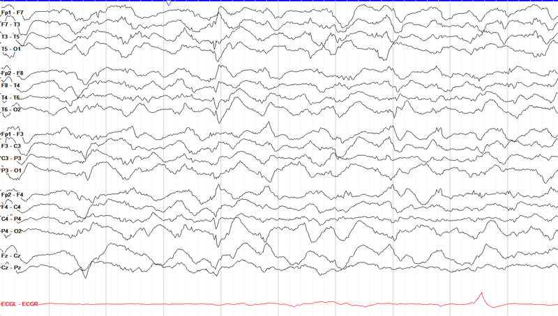 Slowing and other Non-Epileptiform Abnormalities