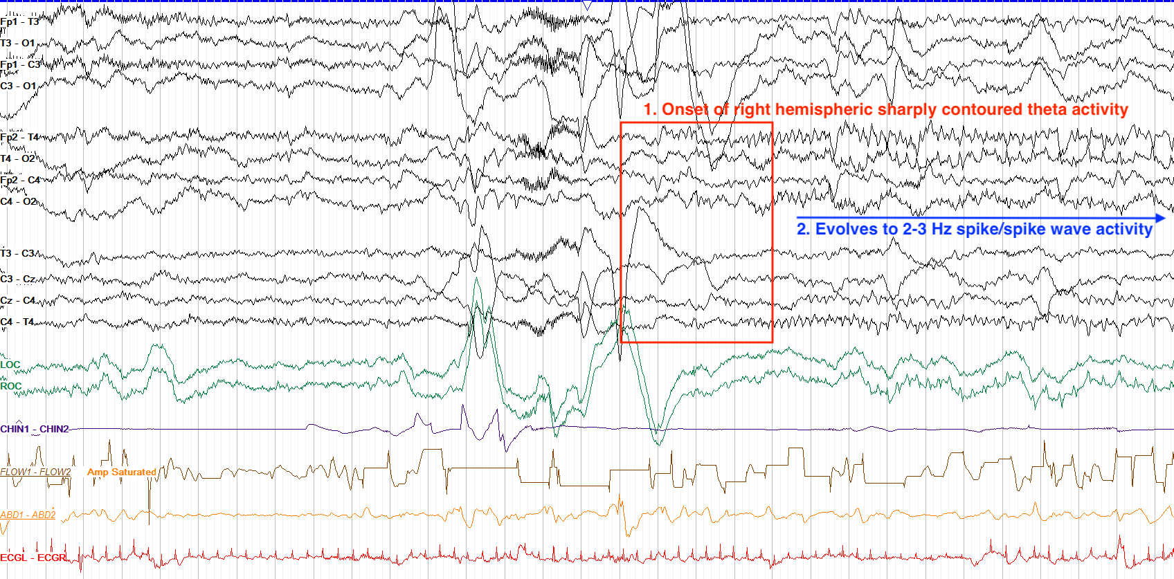The Neonatal EEG