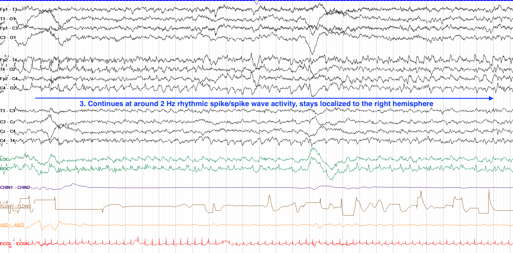 The Neonatal EEG
