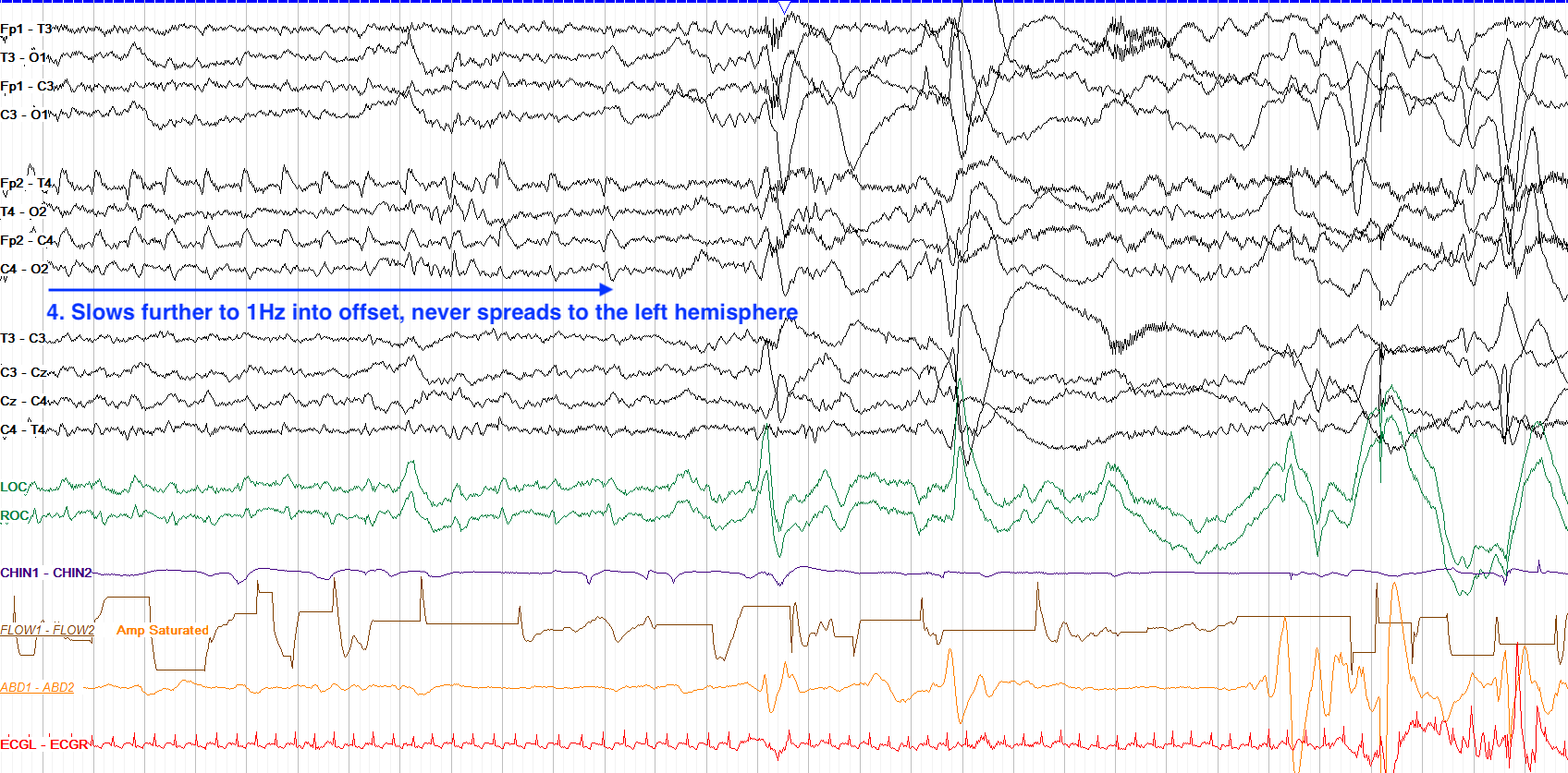 The Neonatal EEG
