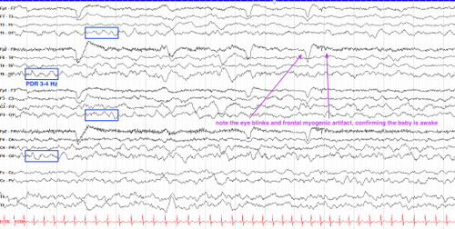 The Pediatric EEG