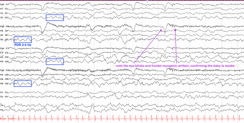 The Pediatric EEG