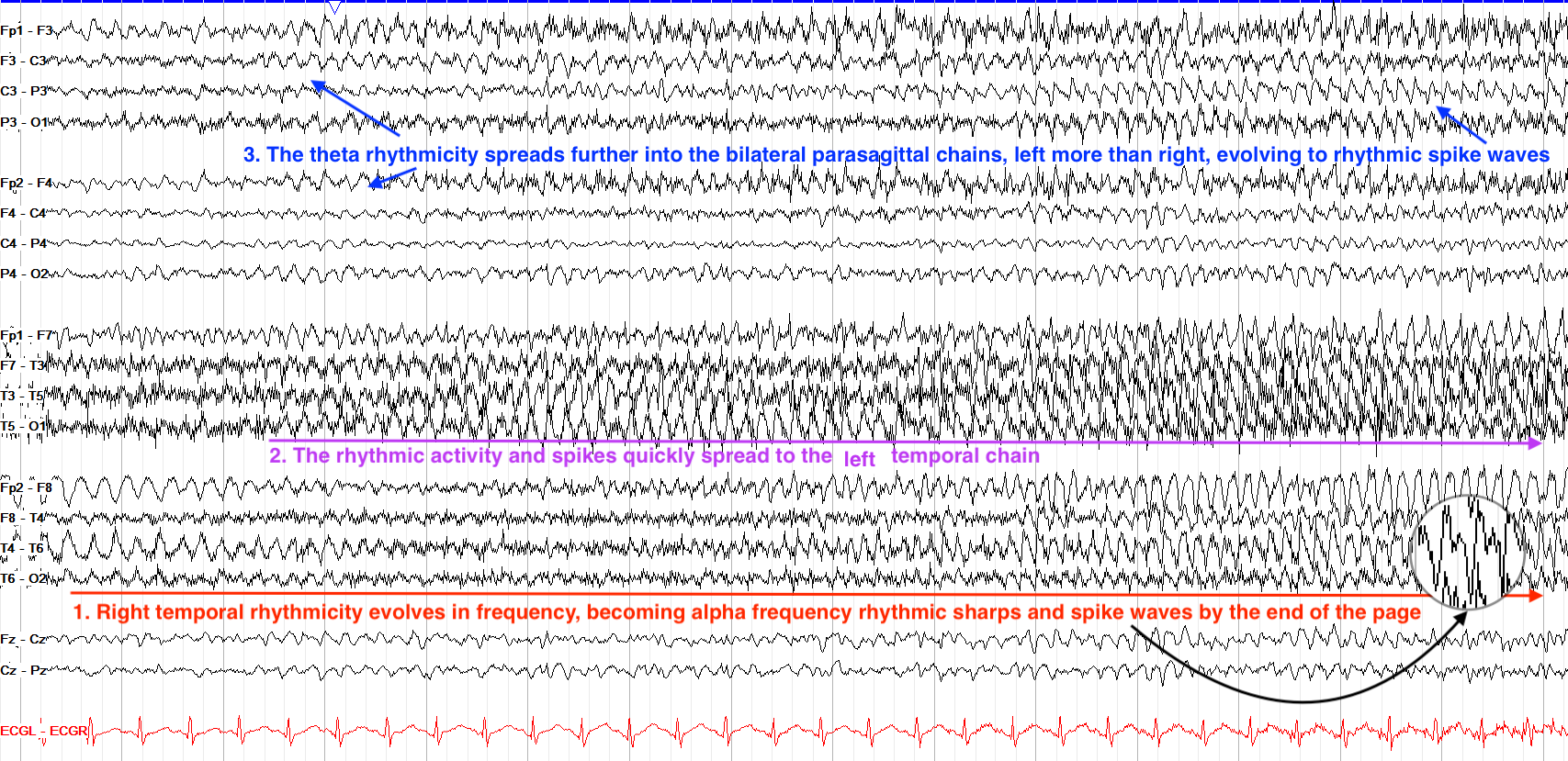 Seizures