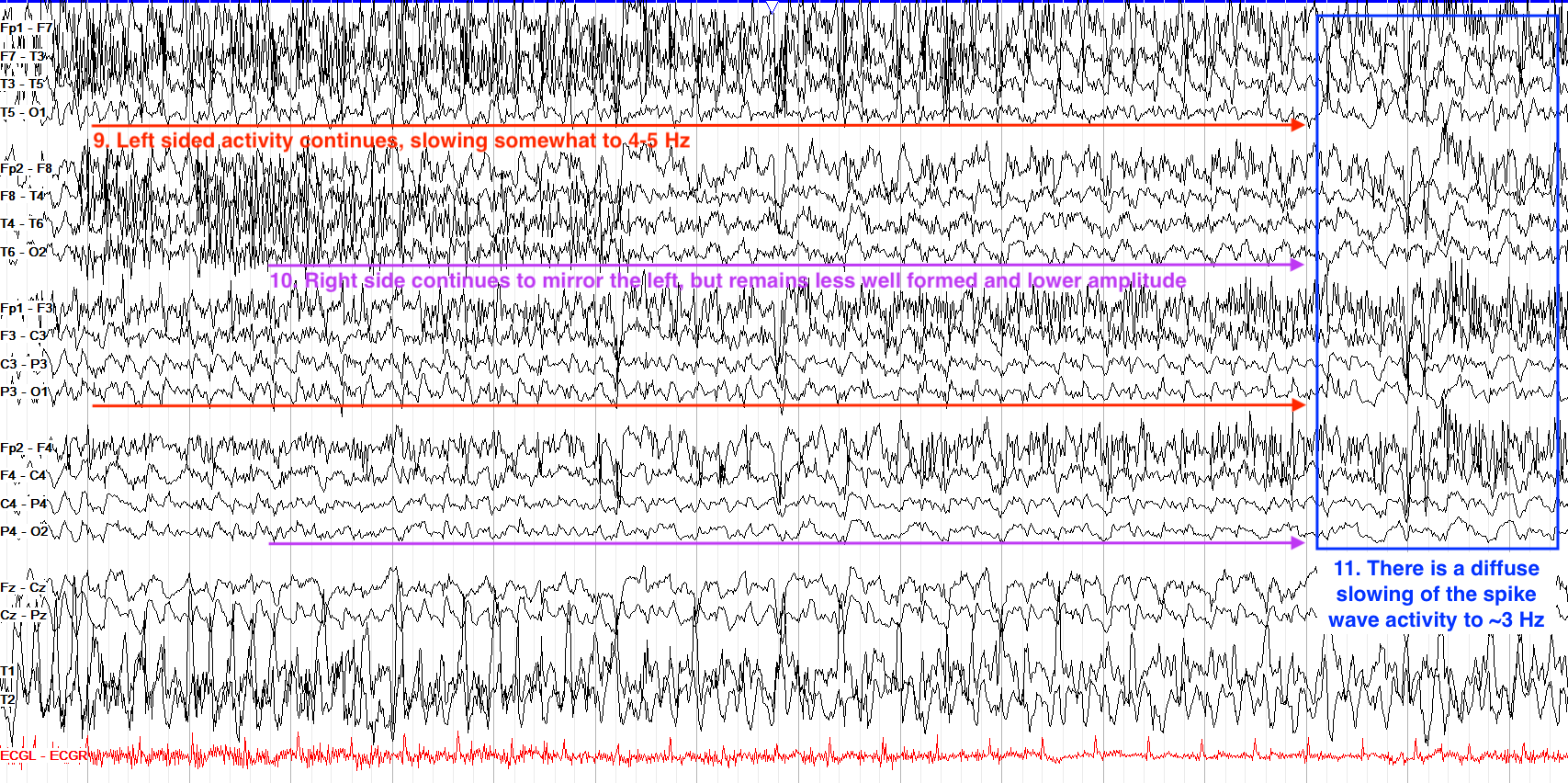 Seizures