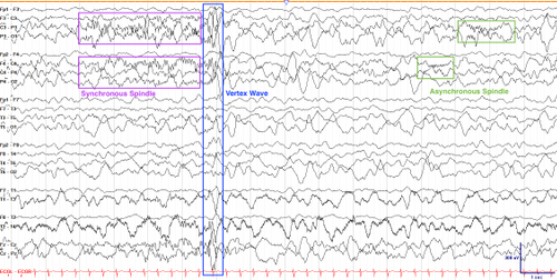 The Pediatric EEG