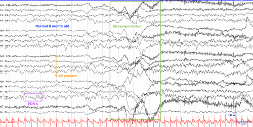 The Pediatric EEG