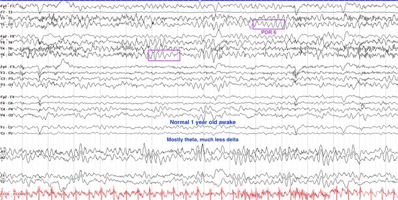 The Pediatric EEG
