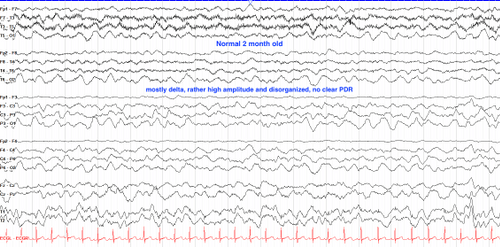 The Pediatric EEG