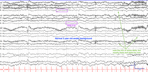 The Pediatric EEG