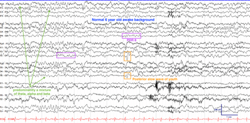 The Pediatric EEG