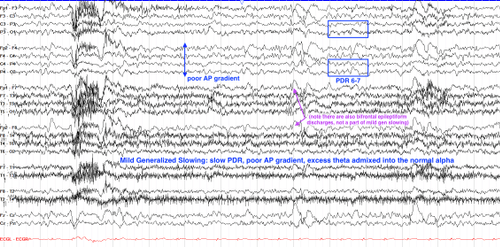 Slowing and other Non-Epileptiform Abnormalities