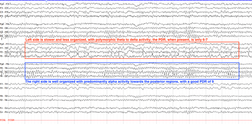 Slowing and other Non-Epileptiform Abnormalities