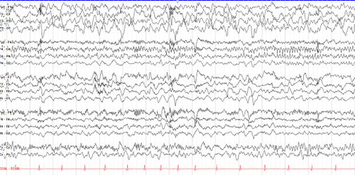 Slowing and other Non-Epileptiform Abnormalities