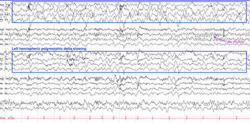 Slowing and other Non-Epileptiform Abnormalities