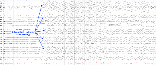 Slowing and other Non-Epileptiform Abnormalities