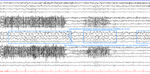 Slowing and other Non-Epileptiform Abnormalities