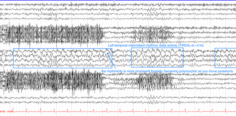 Slowing and other Non-Epileptiform Abnormalities