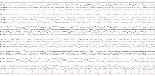 Slowing and other Non-Epileptiform Abnormalities