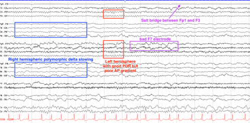 Slowing and other Non-Epileptiform Abnormalities
